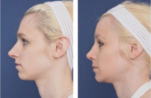 KNOW ABOUT THE SURGERY OF BROW BONE REDUCTION - darkinthedark
